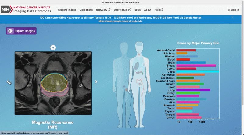 Advancing Cancer Research With Public Imaging Datasets From The ...